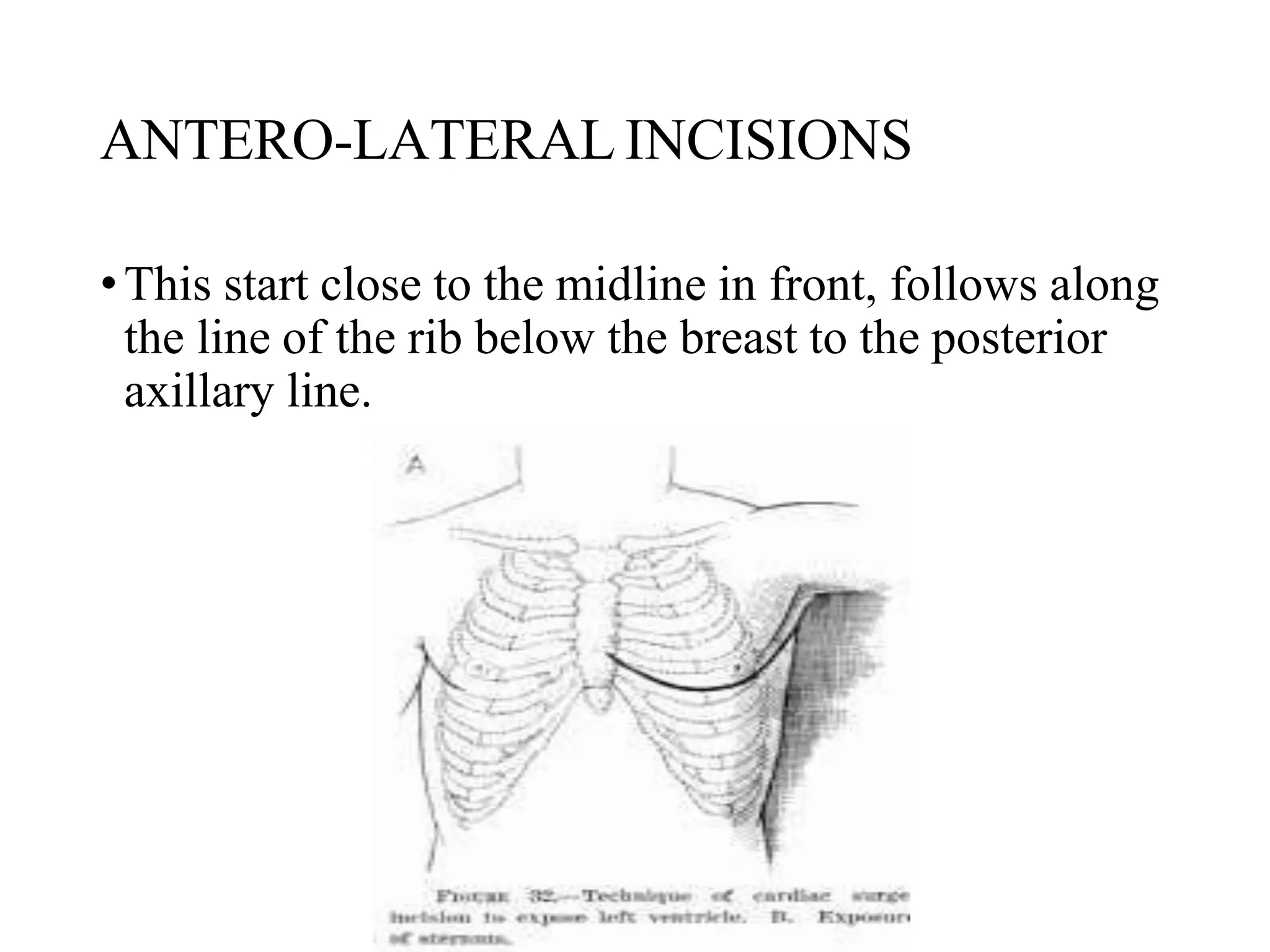 Abdominal incision | PPTX