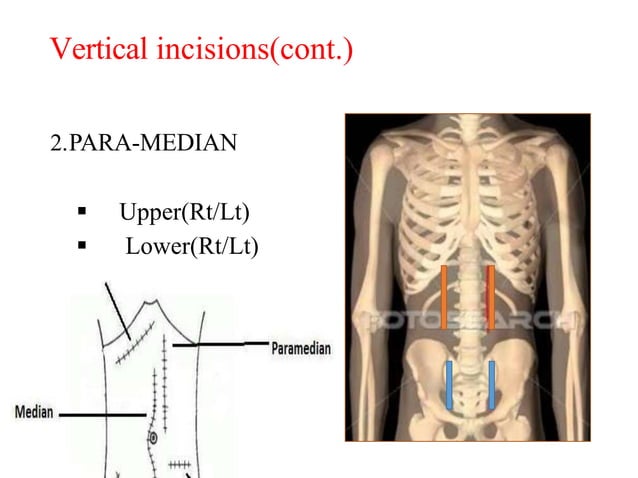 Abdominal incision | PPTX | Pregnancy | Reproductive Health