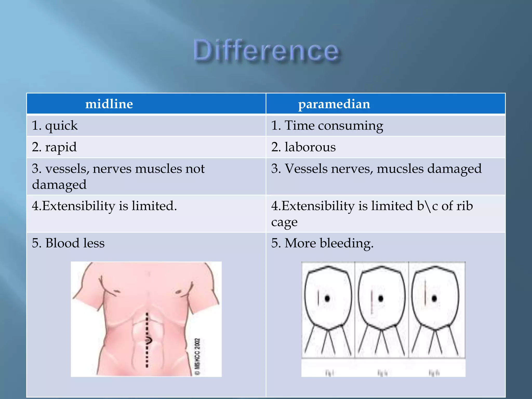 Incisions on abdominal wall’ | PPTX