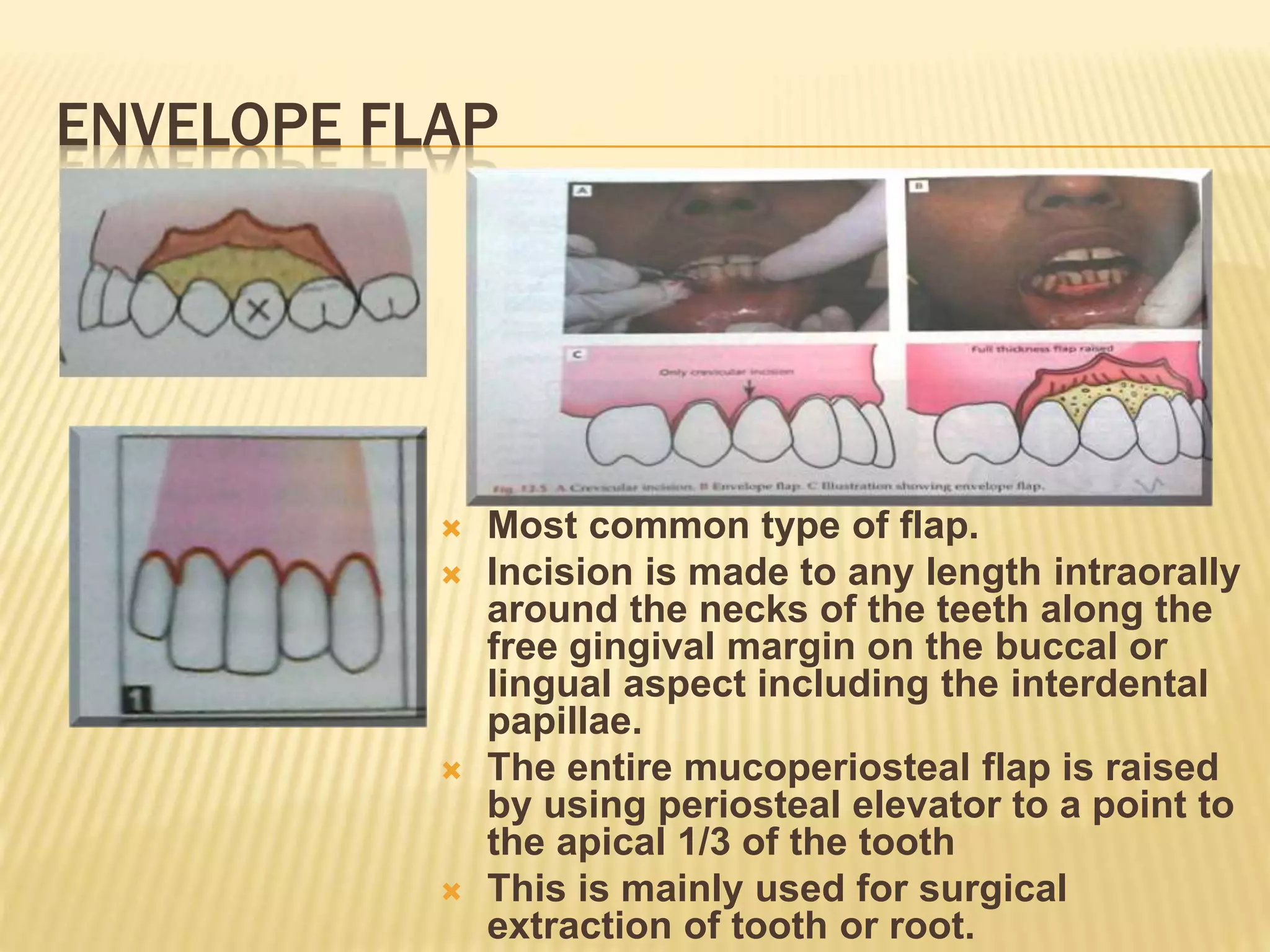 Incision, suture & suture meteri al | PPTX