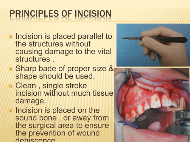 Incision, suture & suture meteri al | PPT