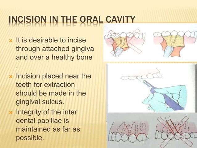 Incision, suture & suture meteri al | PPT