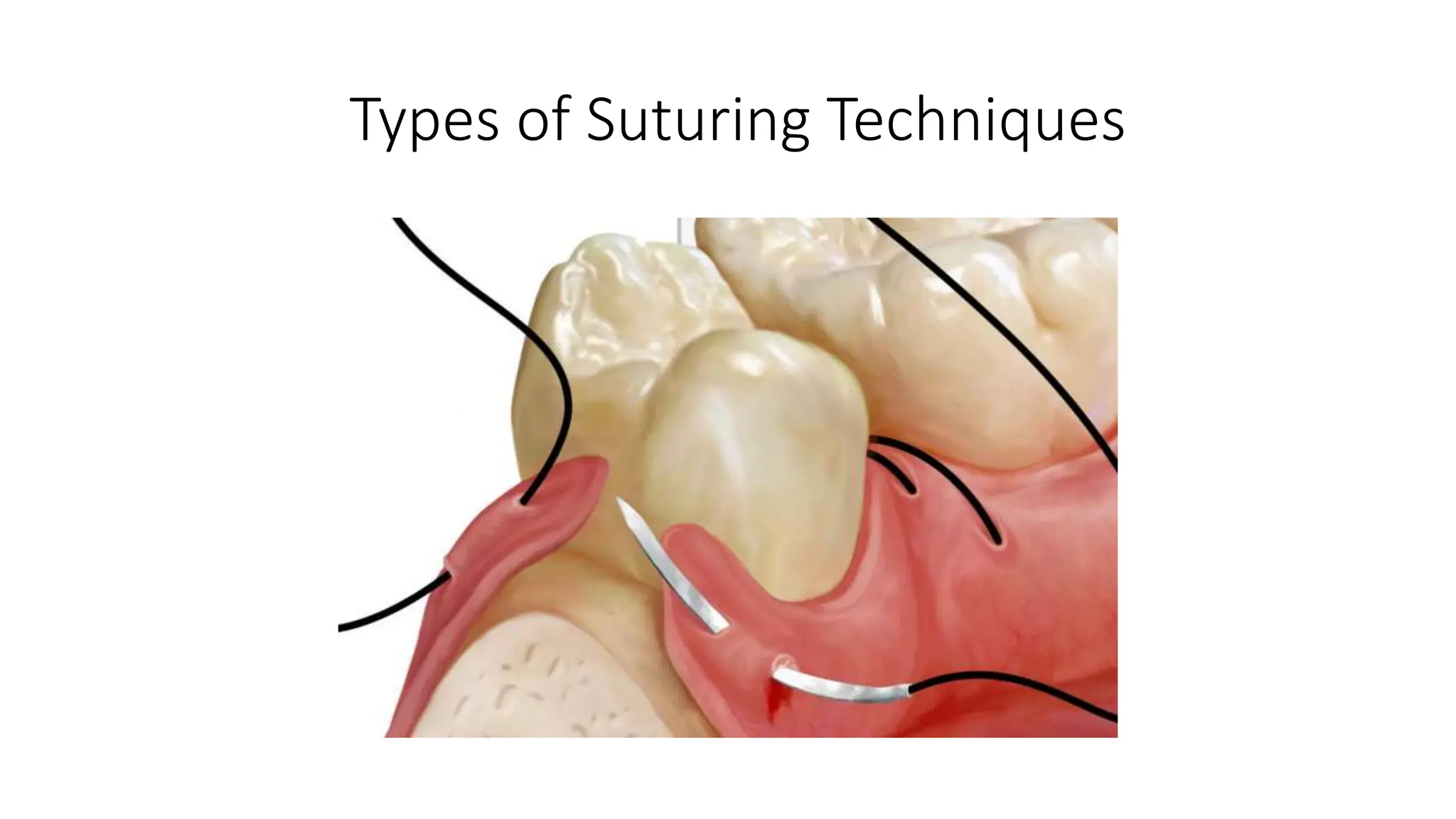 Incision, Suturing Techniques and Complications.pptx