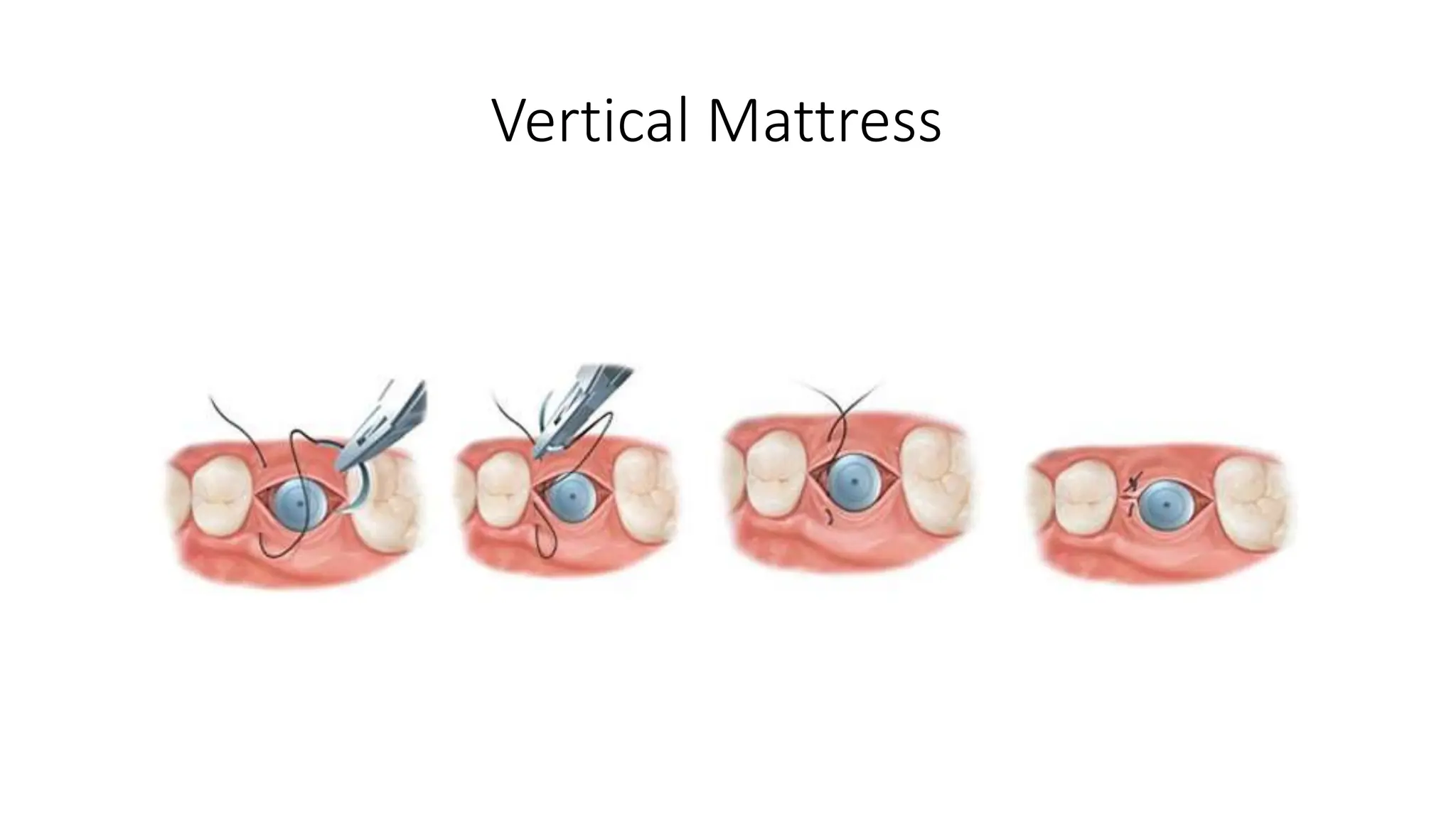 Incision, Suturing Techniques and Complications.pptx