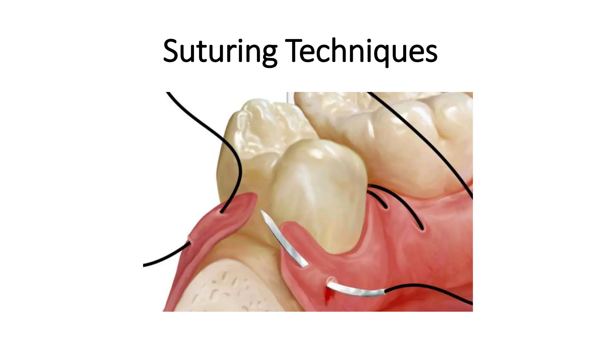 Incision, Suturing Techniques and Complications.pptx