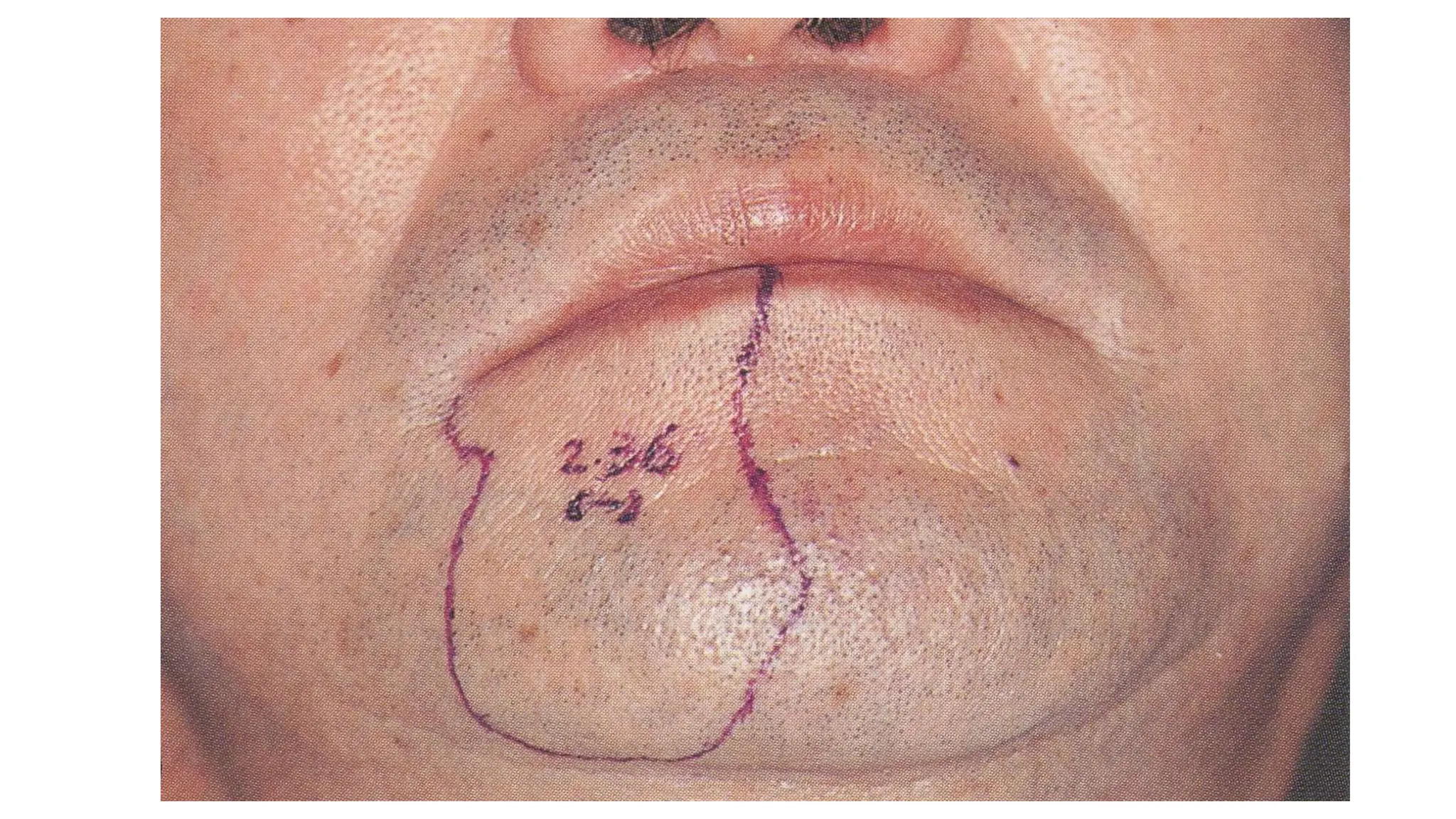 Incision, Suturing Techniques and Complications.pptx