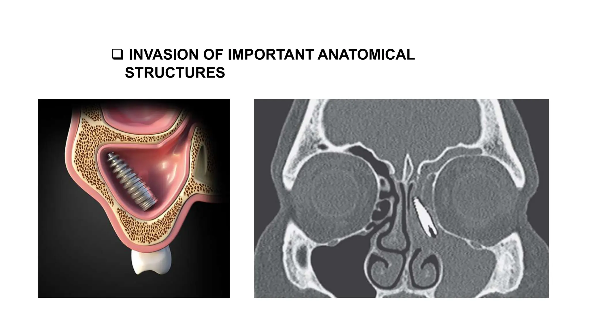 Incision, Suturing Techniques and Complications.pptx