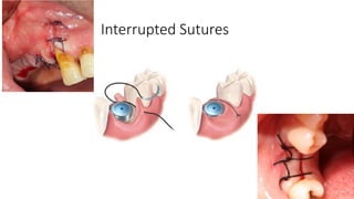 Incision, Suturing Techniques and Complications.pptx