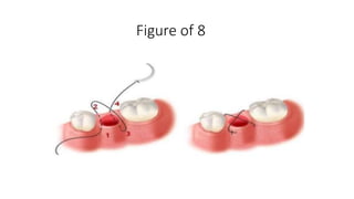 Incision, Suturing Techniques and Complications.pptx