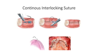 Incision, Suturing Techniques and Complications.pptx