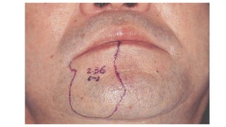 Incision, Suturing Techniques and Complications.pptx
