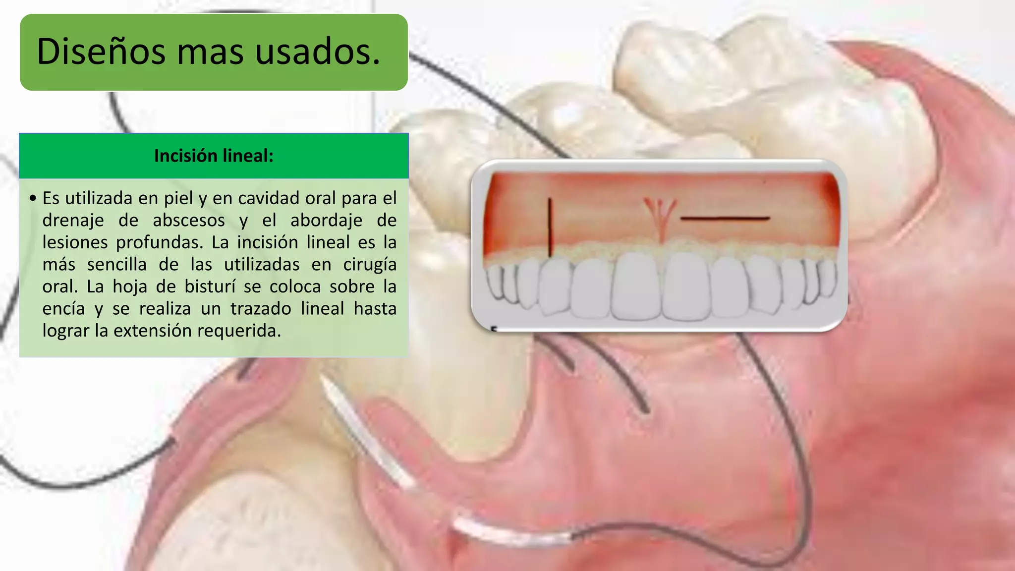 INCISION Y COLGAJOS.pdf