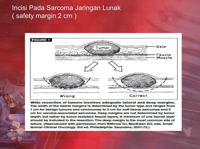 Incisi pada pembedahan keganasan oncology | PPT