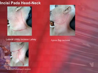 Incisi pada pembedahan keganasan oncology | PPT