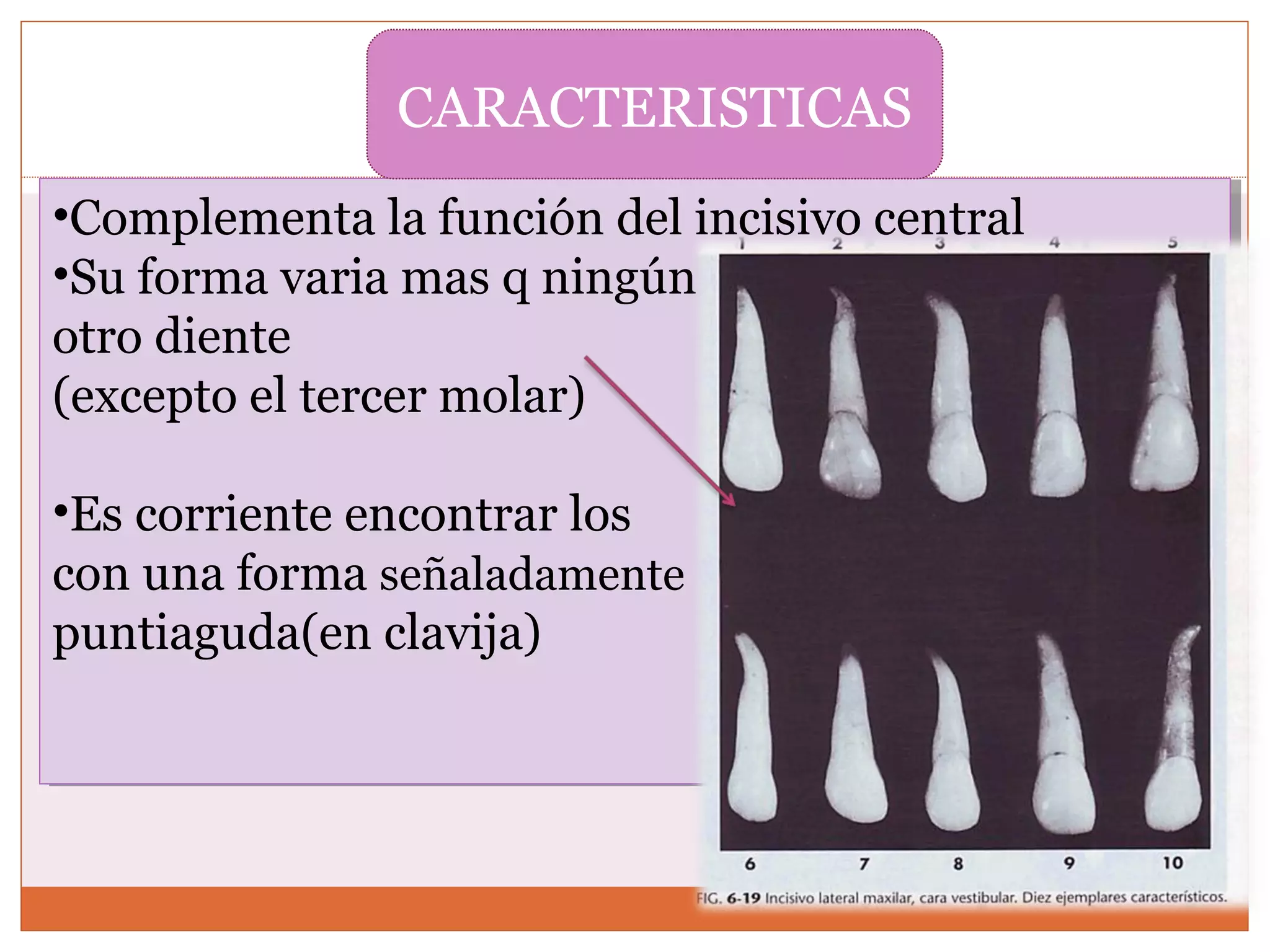 Prostodoncia- Incisivo Maxilar Lateral | PPS