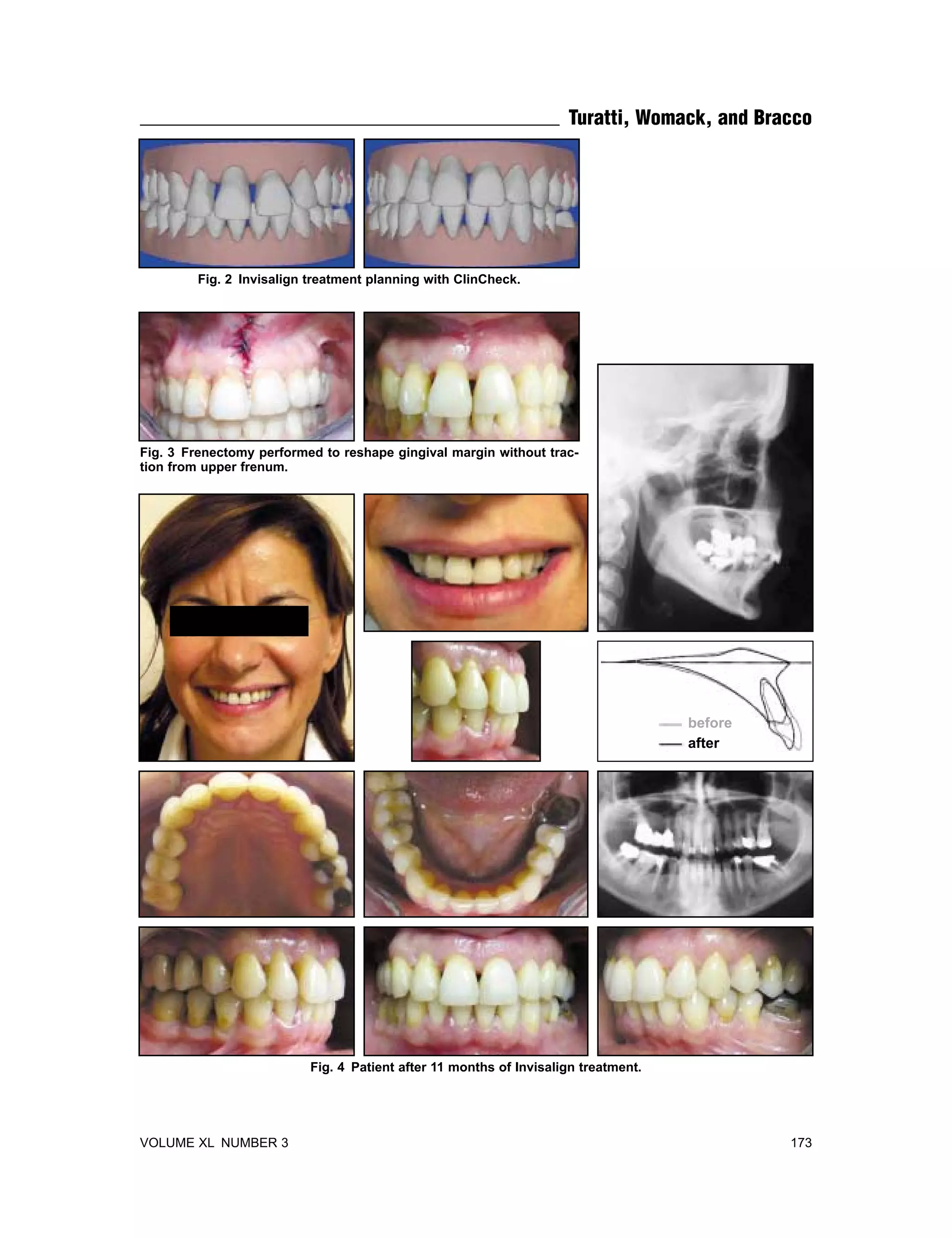 Incisor intrusion with invisalign treatment | PDF