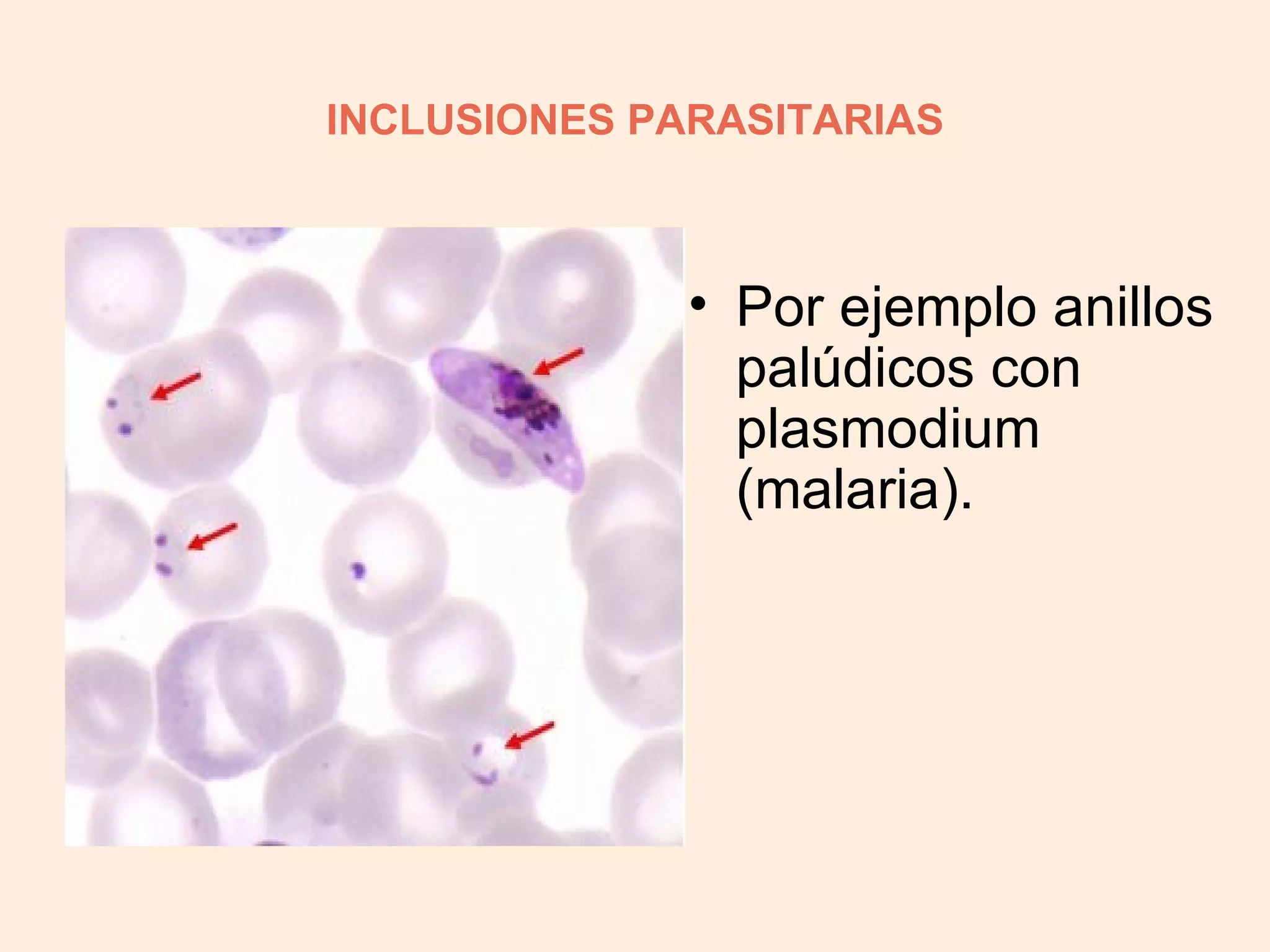 Inclusiones citoplasmaticas y alteraciones morfologicas | PPT | Blood ...