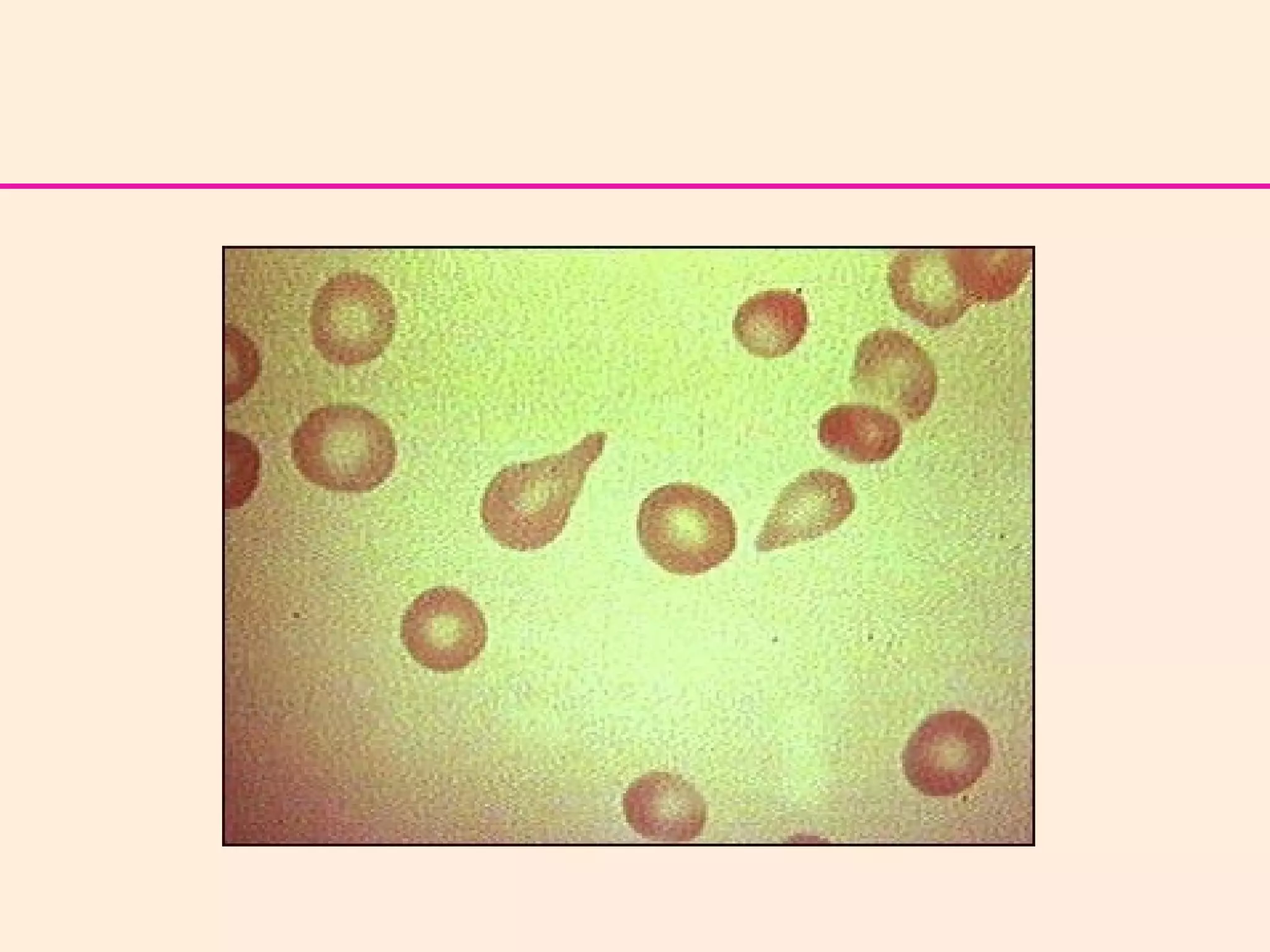 Inclusiones citoplasmaticas y alteraciones morfologicas | PPT | Blood ...