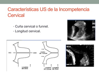 Incompetencia cervical | PPTX