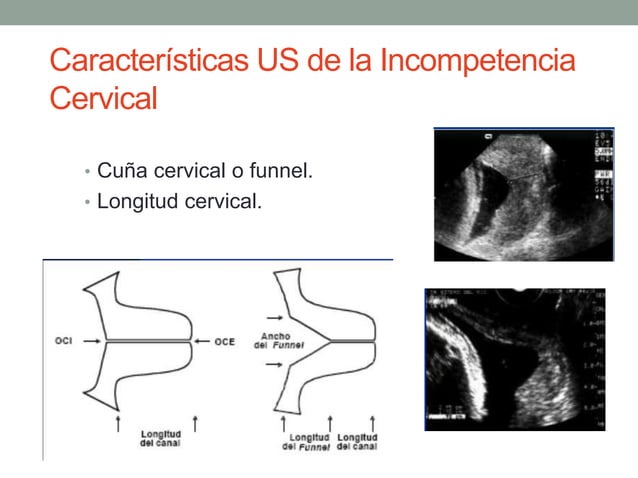 Incompetencia cervical | PPT