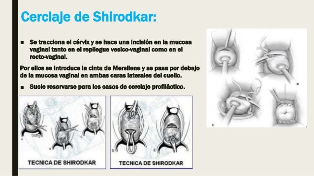 Incompetencia itsmicoCervical