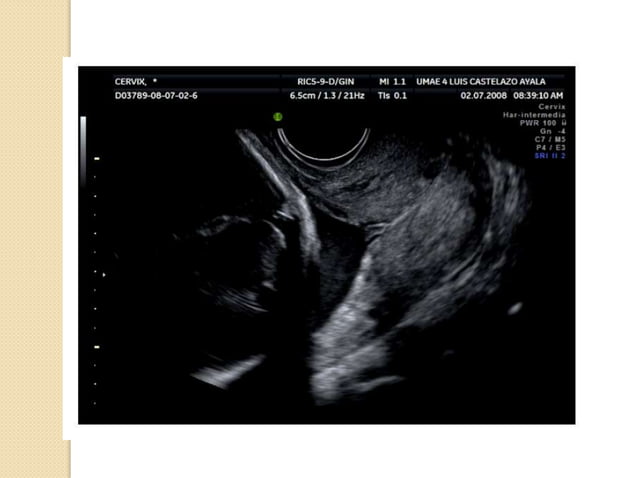Incompetencia itsmico cervical | PPTX