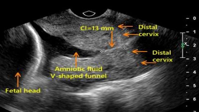 Incompetencia itsmico cervical