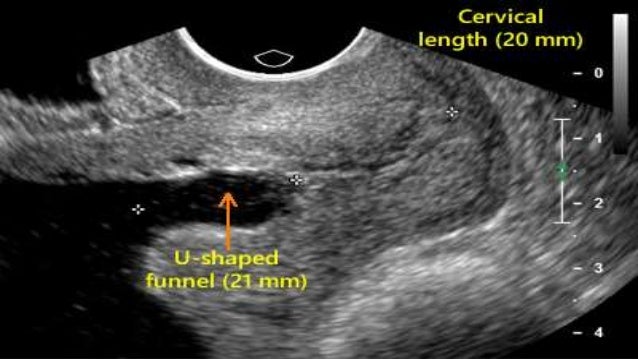 Incompetencia itsmico cervical