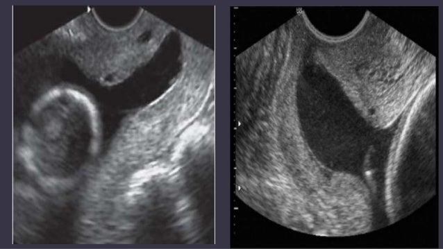 Incompetencia itsmico cervical