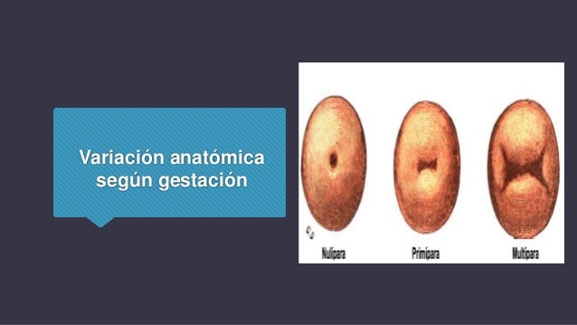 Incompetencia itsmico cervical