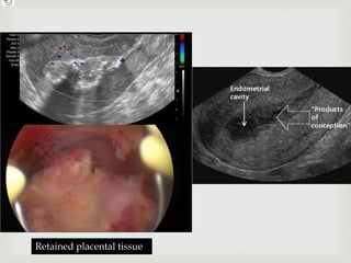 Incomplete Abortion | PPTX