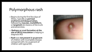 Incomplete kawasaki disease | PPTX