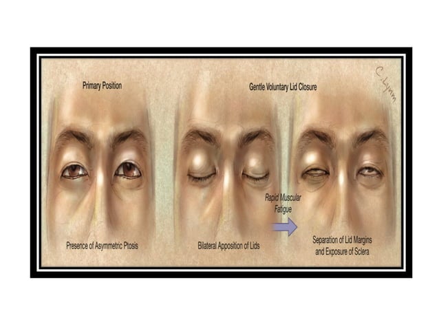 Inconcomitant strabismus types and different tests | PPT