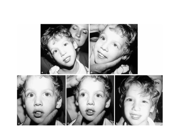 Inconcomitant strabismus types and different tests | PPT