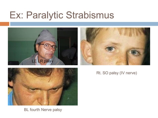 Inconcomitant strabismus types and different tests | PPT