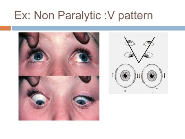 Inconcomitant strabismus types and different tests | PPT
