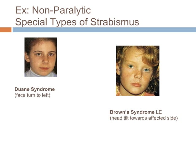 Inconcomitant strabismus types and different tests | PPT