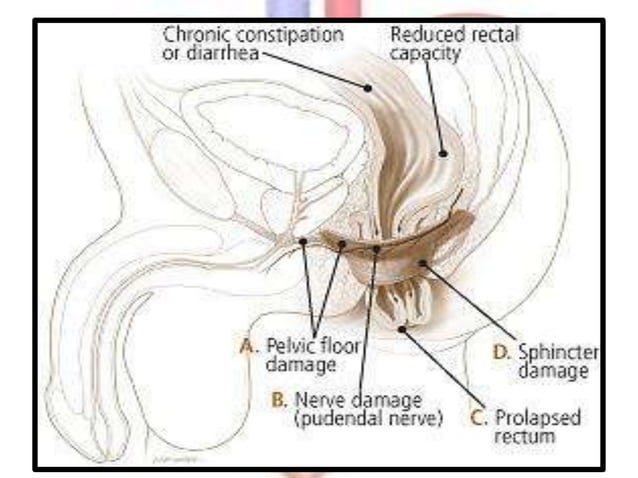 Incontinence bowel and bladder | PPTX | Sexual Conditions | Sexual Health