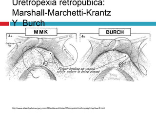 Incontinencia urinaria (1).pptx