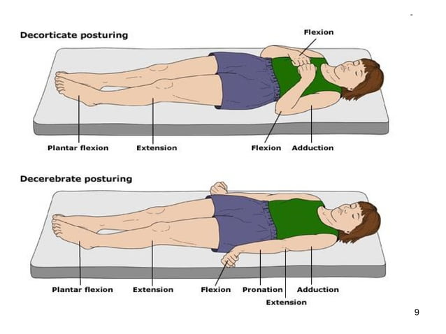 Increased intracranial pressure | PPT