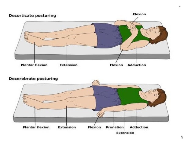 Increased intracranial pressure