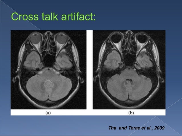 Increased signal intensity of subarachnoid space on FLAIR MRI