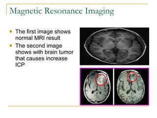 Increase Intracranial Pressure | PPT | Brain and Nervous System ...