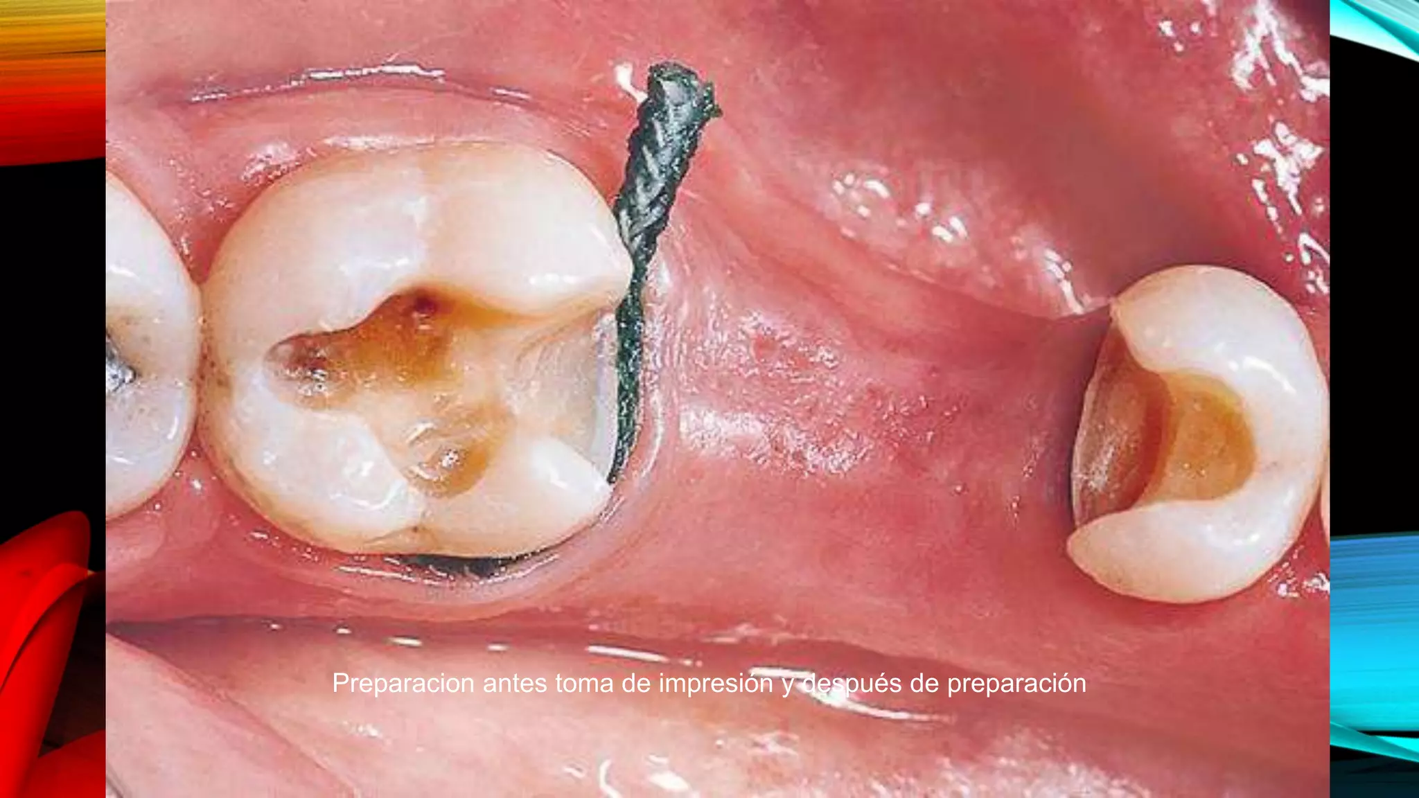 Incrustaciones inlay, onlay y overlay | PPTX