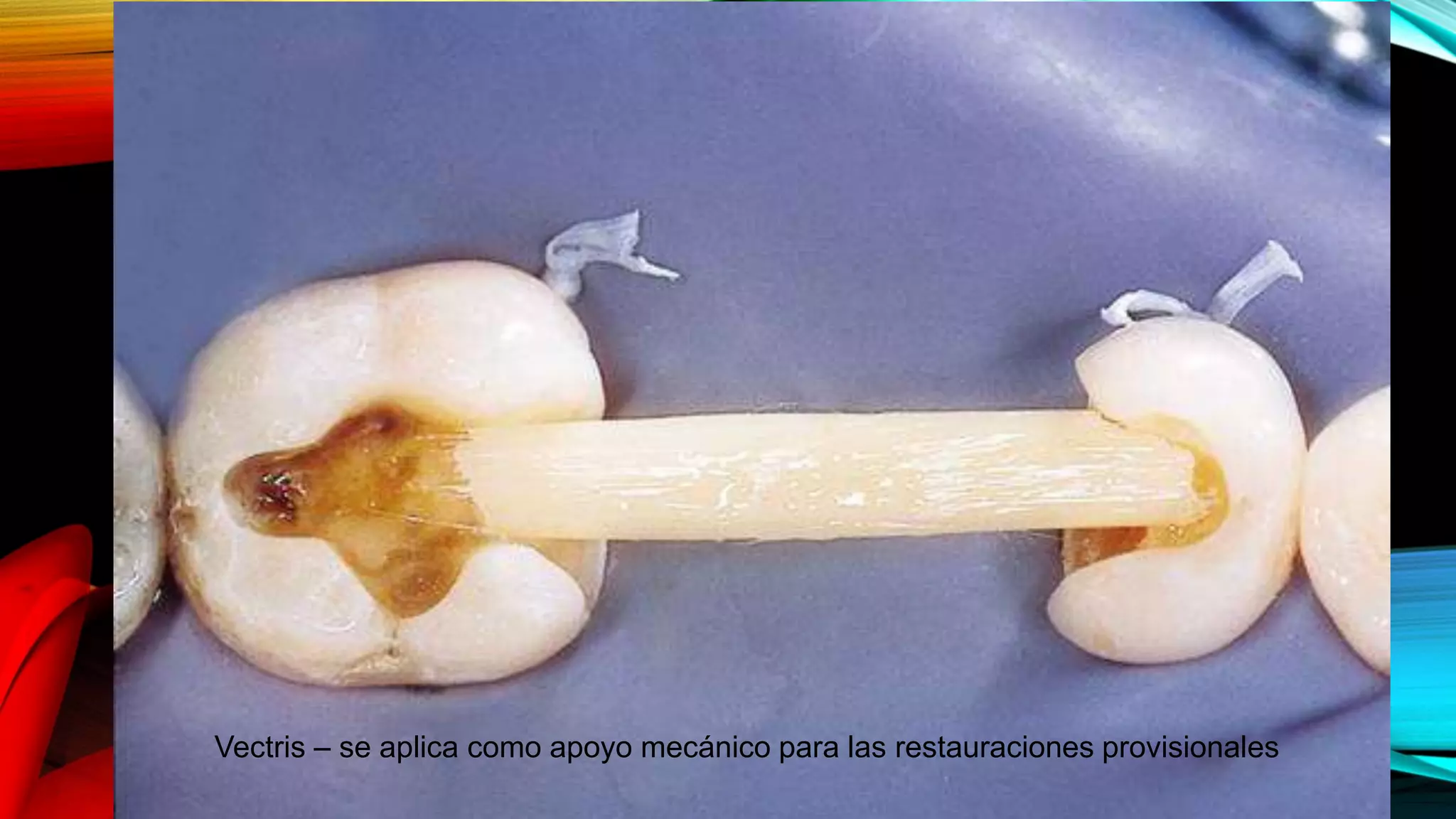 Incrustaciones inlay, onlay y overlay | PPTX