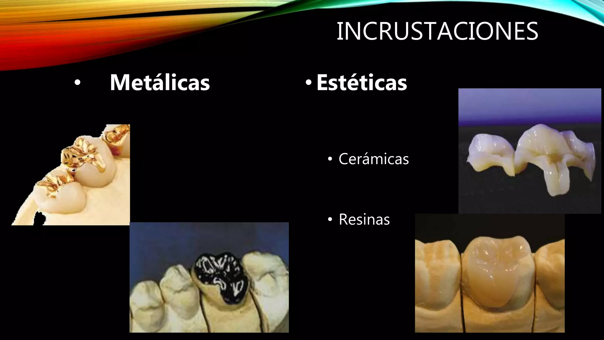 Incrustaciones inlay, onlay y overlay | PPTX