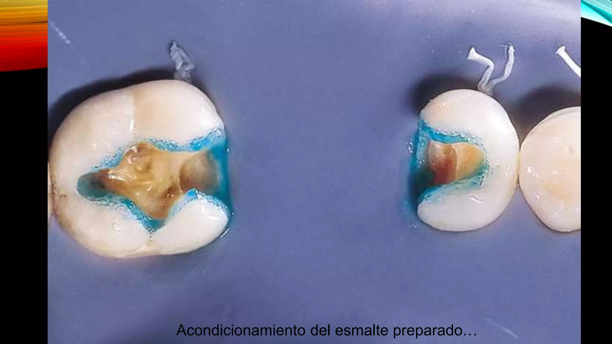 Incrustaciones inlay, onlay y overlay | PPTX