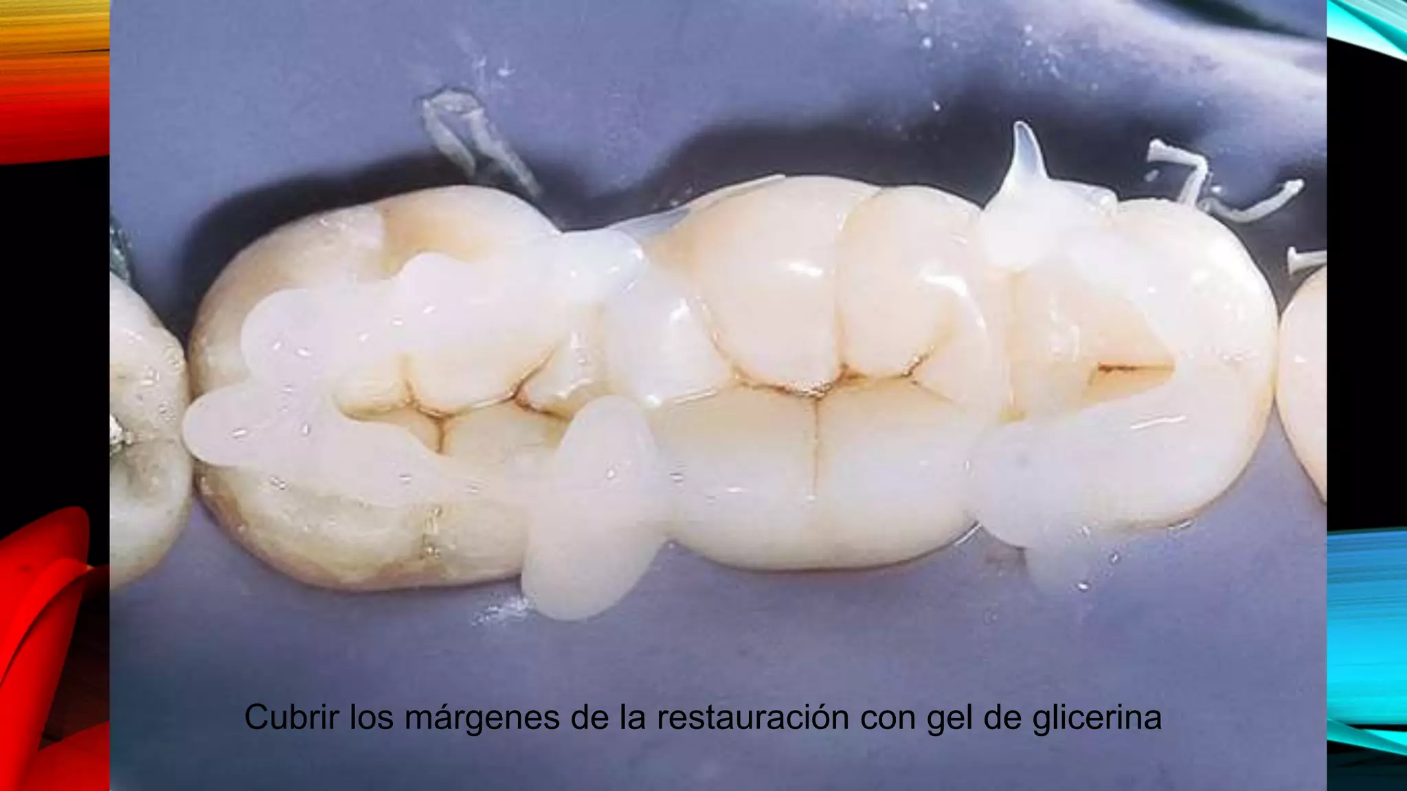 Incrustaciones inlay, onlay y overlay | PPTX