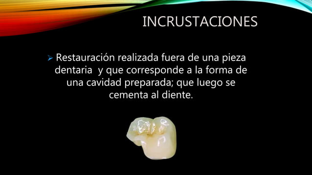 Incrustaciones inlay, onlay y overlay | PPTX