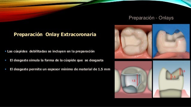 Incrustaciones inlay, onlay y overlay